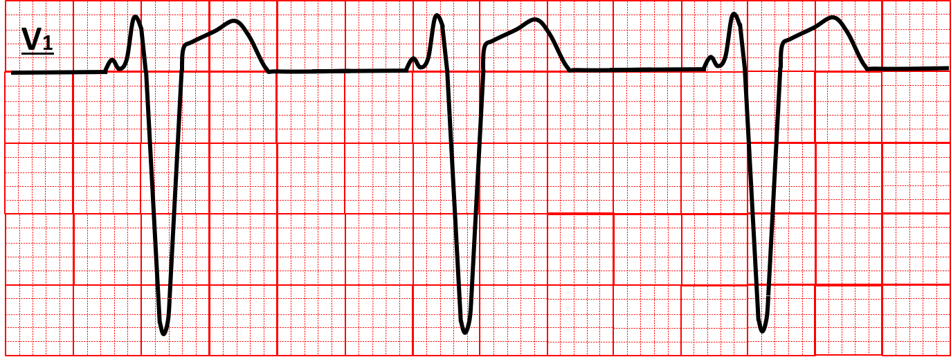 WPW症候群(B型) | プラセボ
