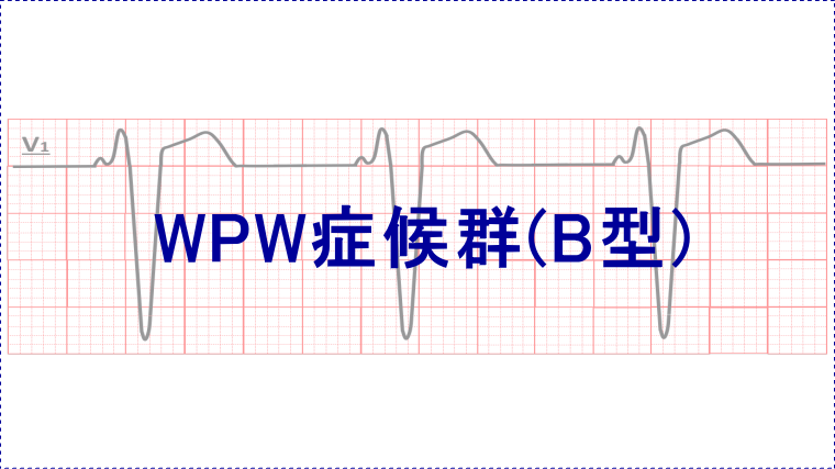WPW症候群(B型) | プラセボ