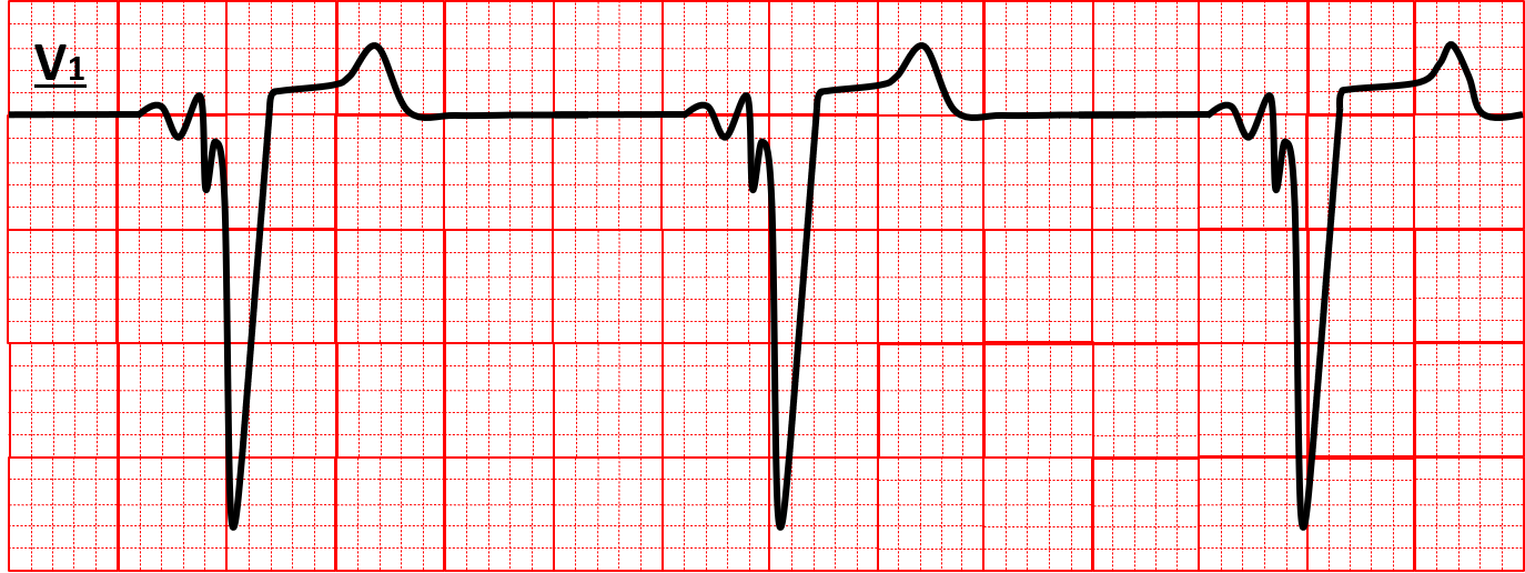 WPW症候群(C型) | プラセボ