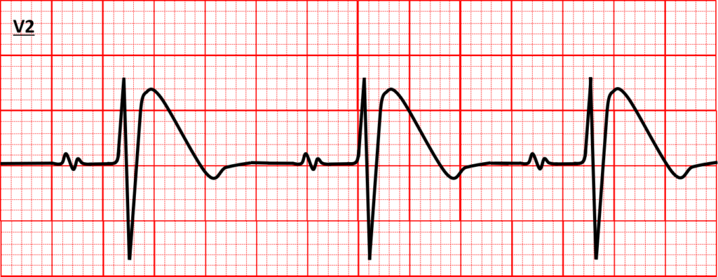 Brugada症候群(Coved type) | プラセボ