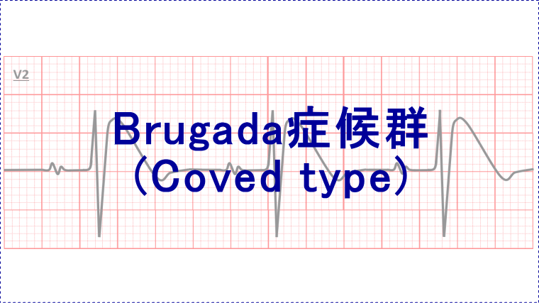 Brugada症候群(Coved type) | プラセボ